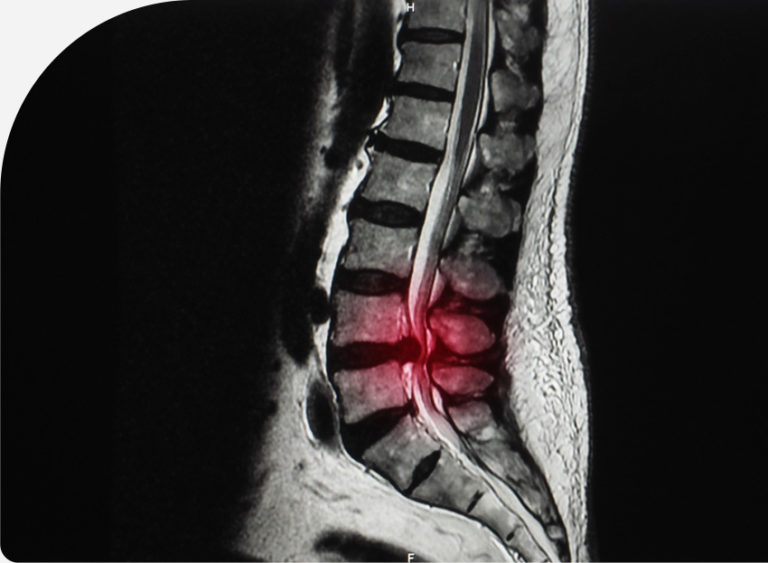 Decompressive Surgery Ronkonkoma & Garden City NY | Spine Medicine and ...