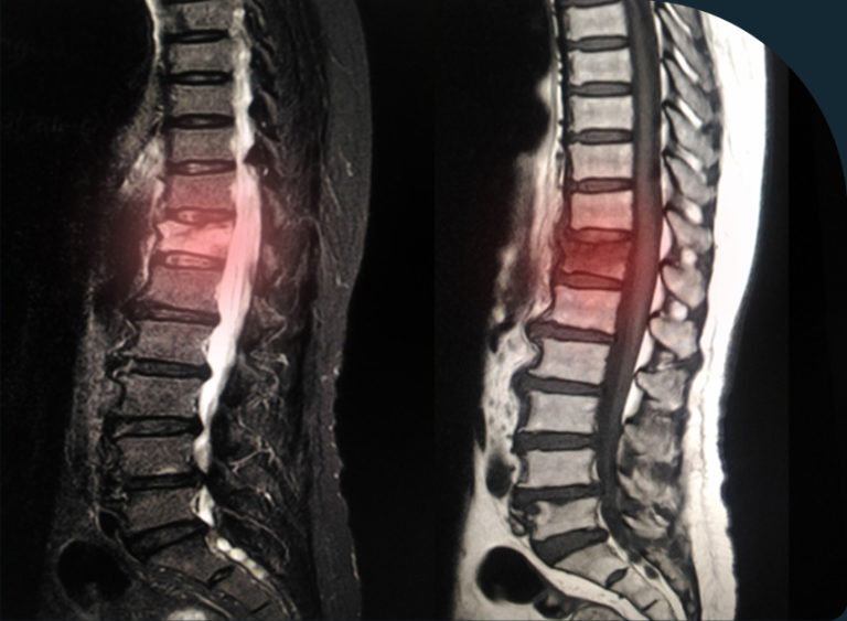 Degenerative Disc Disease | Spine Medicine and Surgery of Long Island ...